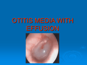 OTITIS MEDIA CLASSIFICATION OF OTITIS MEDIA Acute otitis