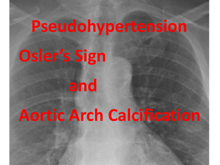 Pseudohypertension, Osler's Sign & Aortic Arch Calcification