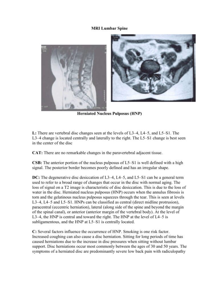 Mri Lumbar Spine Report Sample Fill Online Printable - vrogue.co