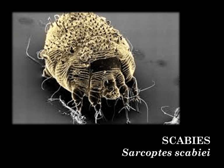Scabies: Symptoms, Diagnosis & Treatment - Medical Presentation