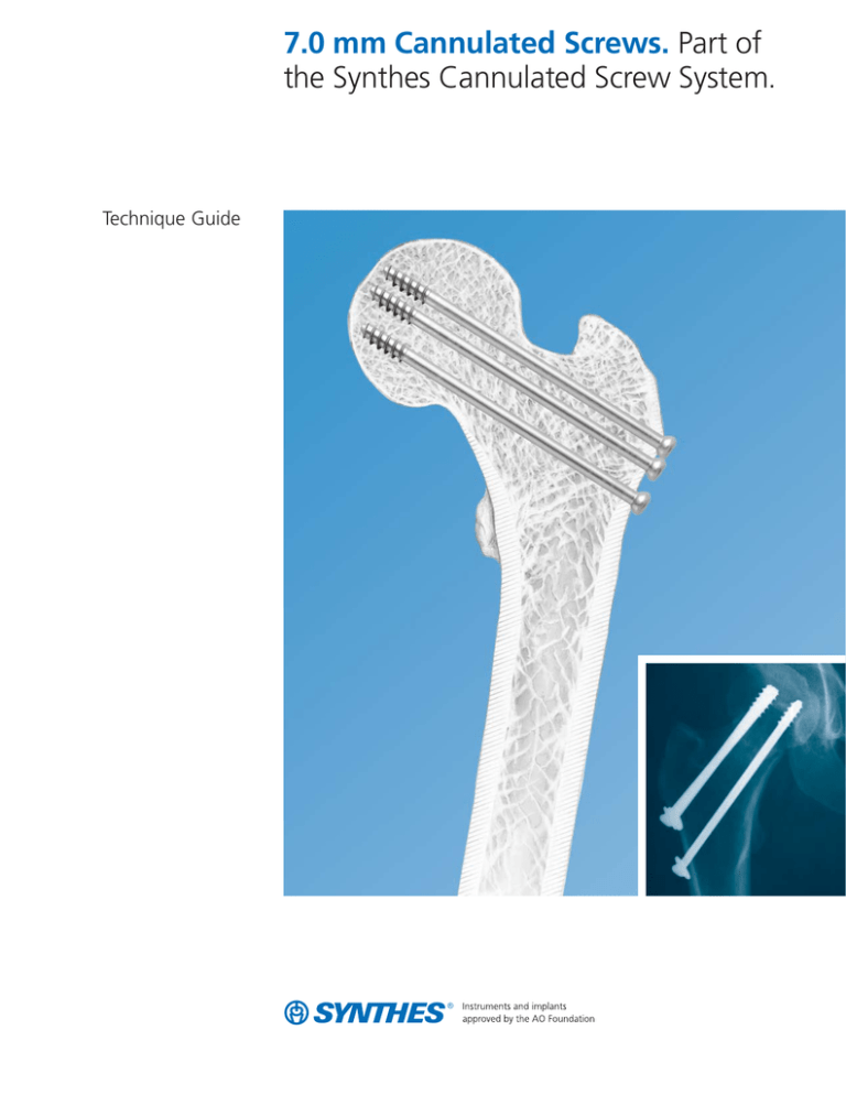 7.0 mm Cannulated Screw Technique Guide | Synthes System