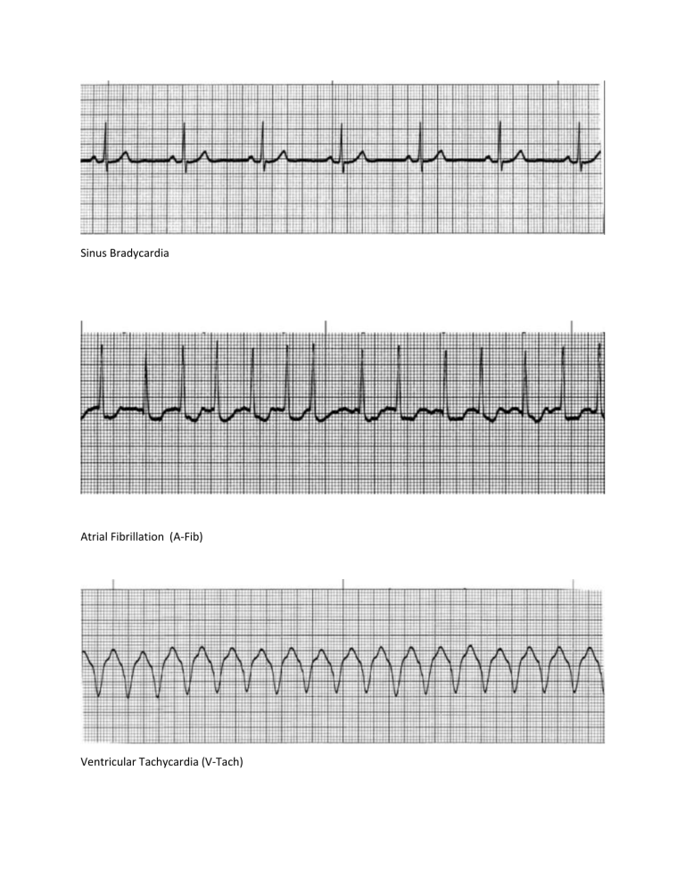 Cardiac Arrhythmias: Identification and Treatment Guide